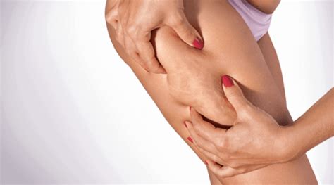 Lipedema Vs Cellulite Heres How You Can Differentiate Them Xcode Life