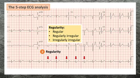 Regularly Irregular Rhythm