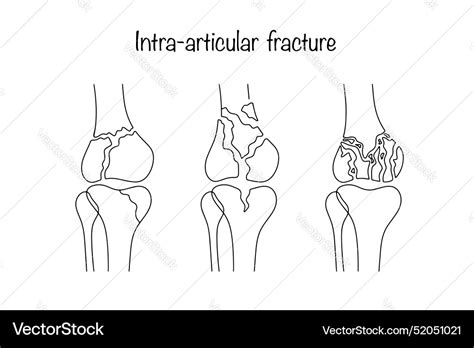 Intra Articular Fracture Royalty Free Vector Image