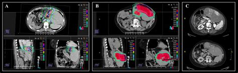 Advanced And Emerging Radiation Therapy Approaches For Intrahepatic Cholangiocarcinoma