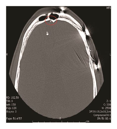 Case 3 A Preoperative Ct Scan Showing A Csf Leak In The Posterior