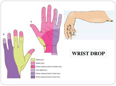 Ppt Nerves Of Upper Limb And Their Lesions Powerpoint Presentation Id