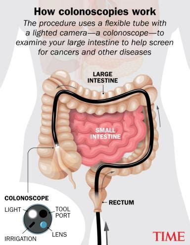 What To Expect At A Colonoscopy Time