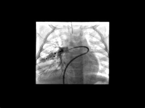 Pulmonary Arteriovenous Malformations Vascular Plug Embolisation YouTube