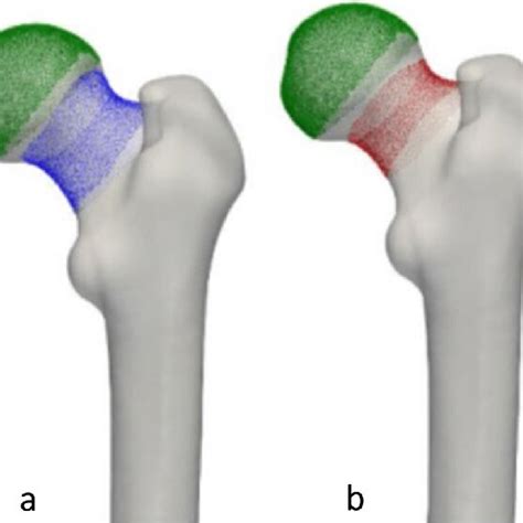 Methods 2 And 3 To Assess Femoral Neck Using 3d Technology A Method 2