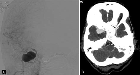 Patient 3 A Dsa Of Partially Thrombosed Of Aneurysm Of Right Internal Download Scientific