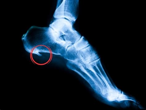 Expert Bone Spur Removal Surgery Dr Pamela Mehta San Jose And Los Gatos