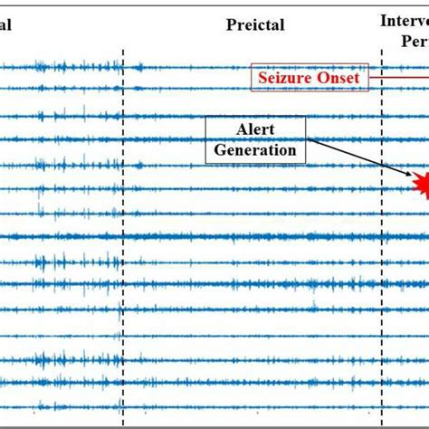 An Illustration Of Multichannel EEG Signal With Different Seizure Stages Download Scientific