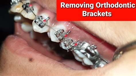 Removing Orthodontic Brackets Howto Remove Removing Dental Bracket