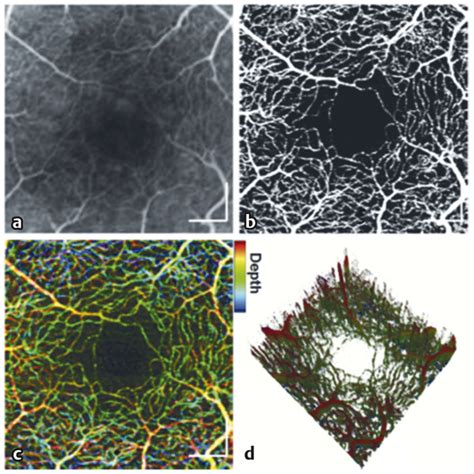 4 Phase Variance Optical Coherence Tomography Ento Key