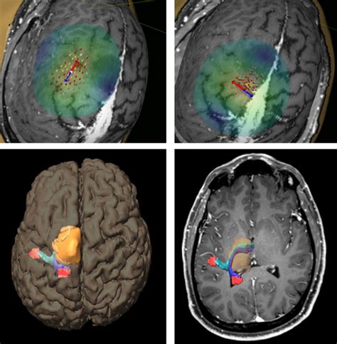 Navigated Transcranial Magnetic Stimulation Ntms Neurosurgery Inselspital Bern