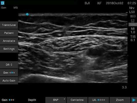 Adductor Canal Block Video Vastus Medialis Nerve Youtube
