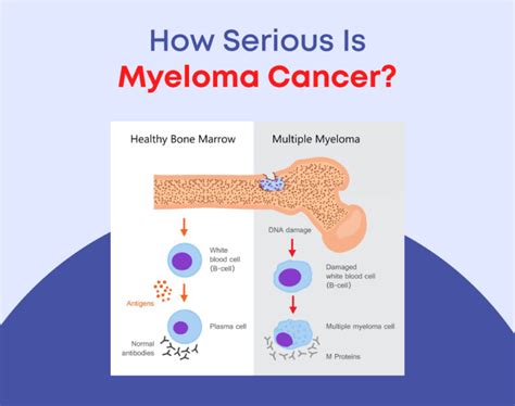 How Serious Is Myeloma Cancer
