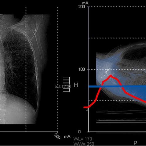 modulation of radiation exposure with automated exposure control aec