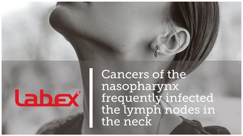 Cancers Of The Nasopharynx Frequently Infected The Lymph Nodes In The
