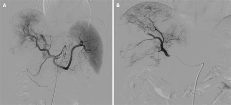 Drug Eluting Bead Transarterial Chemoembolization As Neoadjuvant