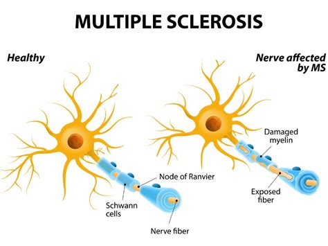 VUMERITY For The Treatment Of Multiple Sclerosis USA