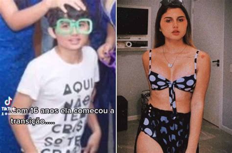 Identical Twins 19 Undergo Sex Change Surgery Together In Brazil