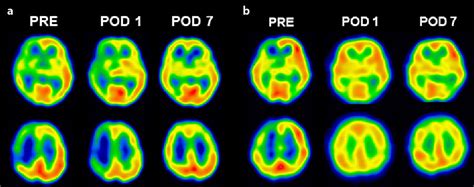 Figure 1 From Transient Global Cerebral Hypoperfusion As A