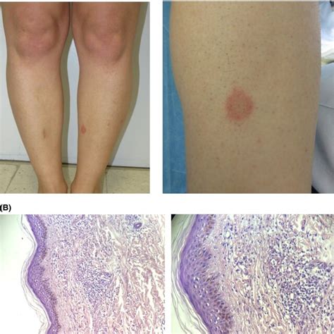 Case 6 Maculopustular Eruption On The Neck And Chest On Day 8 Of