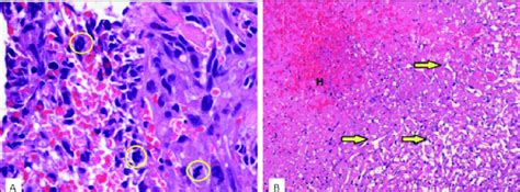 A The Tumour Cells Are Pleomorphic Hyperchromatic With Eosinophilic