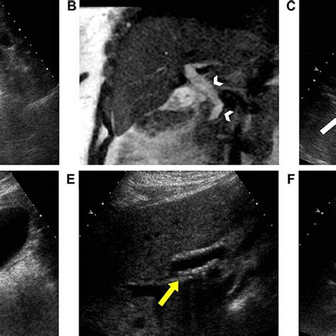 Improvement Of Stone Burden After Ercp And Delivery A 20 Year Old