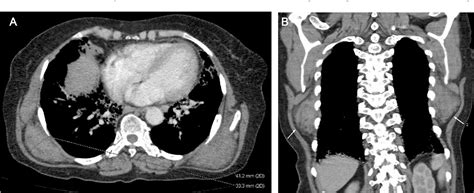 Figure 1 From Prevalence Of Elastofibroma Dorsi On Ct Is It Really An
