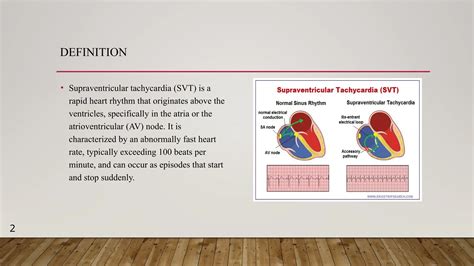 Case Presentation On Svt Supra Ventricular Tachycardia Pptx