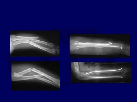 How To Reduce Both Bone Forearm Fracture