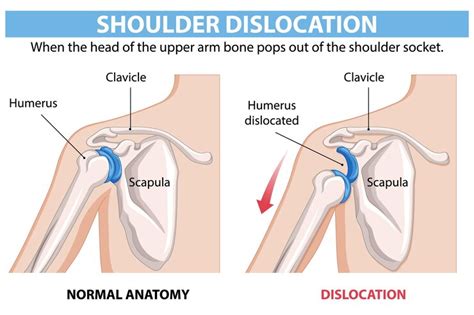 Free Vector Shoulder Dislocation Anatomy Illustration