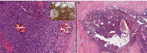 Primary Kaposi Sarcoma Of The Subcutaneous Tissue A Rare Clinical