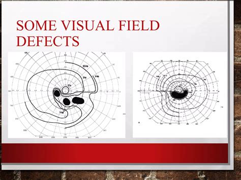 Visual Field Testing And Interpretation Ppt Eye And Vision