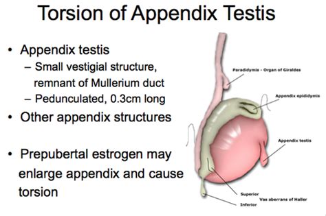 Torsion Of Appendix Testis Torsion Of Appendix Testis