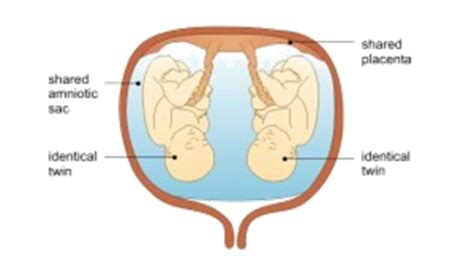 Dmso 2245 Week 6 Multiple Gestation Flashcards Quizlet