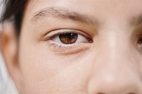 Pre Myopia Can We Intervene In Time