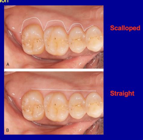Perio 3 Perio Surgery Therapy Ch 61 Flashcards Quizlet
