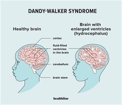 Hvad Er Dandy Walker Syndrom Med Dk
