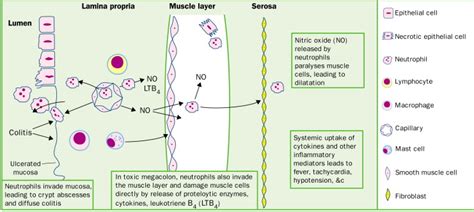 Toxic Megacolon C Diff
