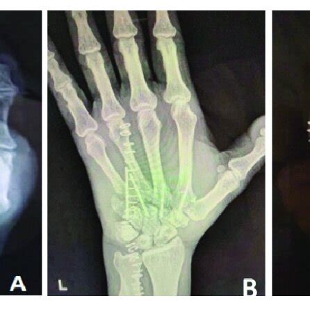 A Lateral Radiographs Showing A Nd To Th Carpometacarpal