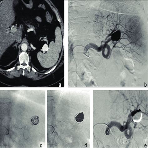 Small Pseudoaneurysm Psa Of The Profunda Femoral Artery White