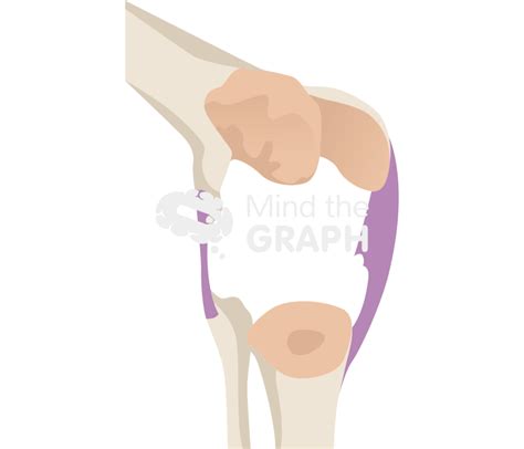 Total Knee Arthroplasty Revision Bone Loss4