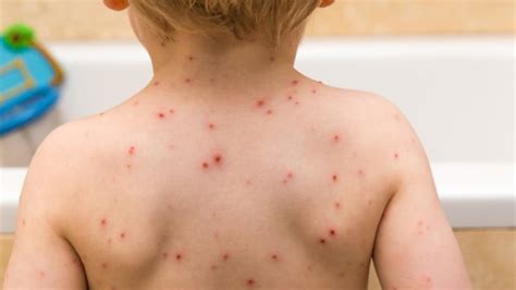 Is It Shingles Virus Or Something Else Everyday Health