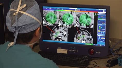 Mri Guided Surgical Ablation For Brain Tumors Broadcastmed