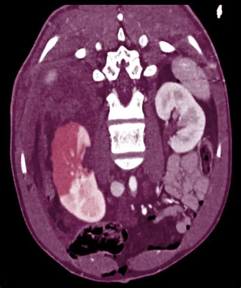 Renal Infarct Oblique Sagittal Compted Tomography Ct Scan Of The The