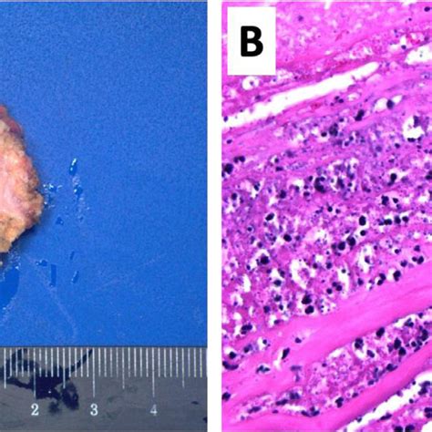 Excised Pulmonic Valve Homograft Showing Adherent Vegetations Download Scientific Diagram