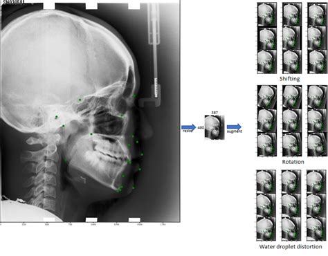 Locating Cephalometric Landmarks With Multi Phase Deep Learning