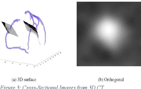 Figure 1 From Transfer Learning Based Vascular Stenosis Detection