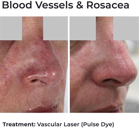 Best Rosacea Treatment Packages Brisbane Cutis Dermatology Best Rosacea Treatment Packages Brisbane Cutis Dermatology