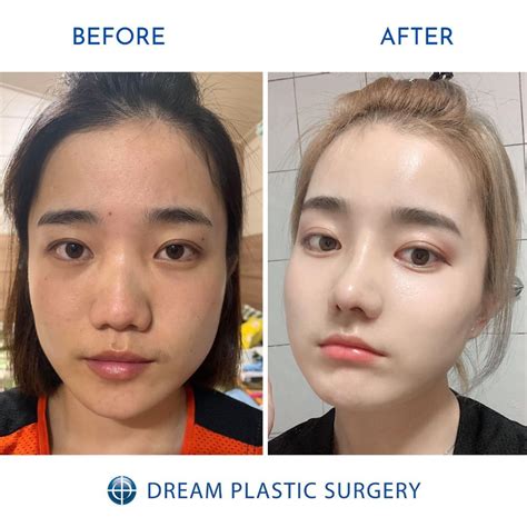Dream Surgery Before And After Korean Plastic Surgery Artofit