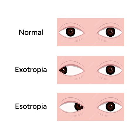 Premium Vector Eye Problem Disease Strabismus Normal Esotropia Exotropia